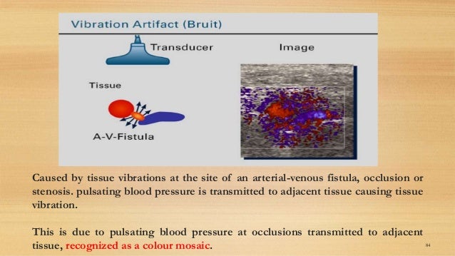 Doppler Effect - Ultrasound