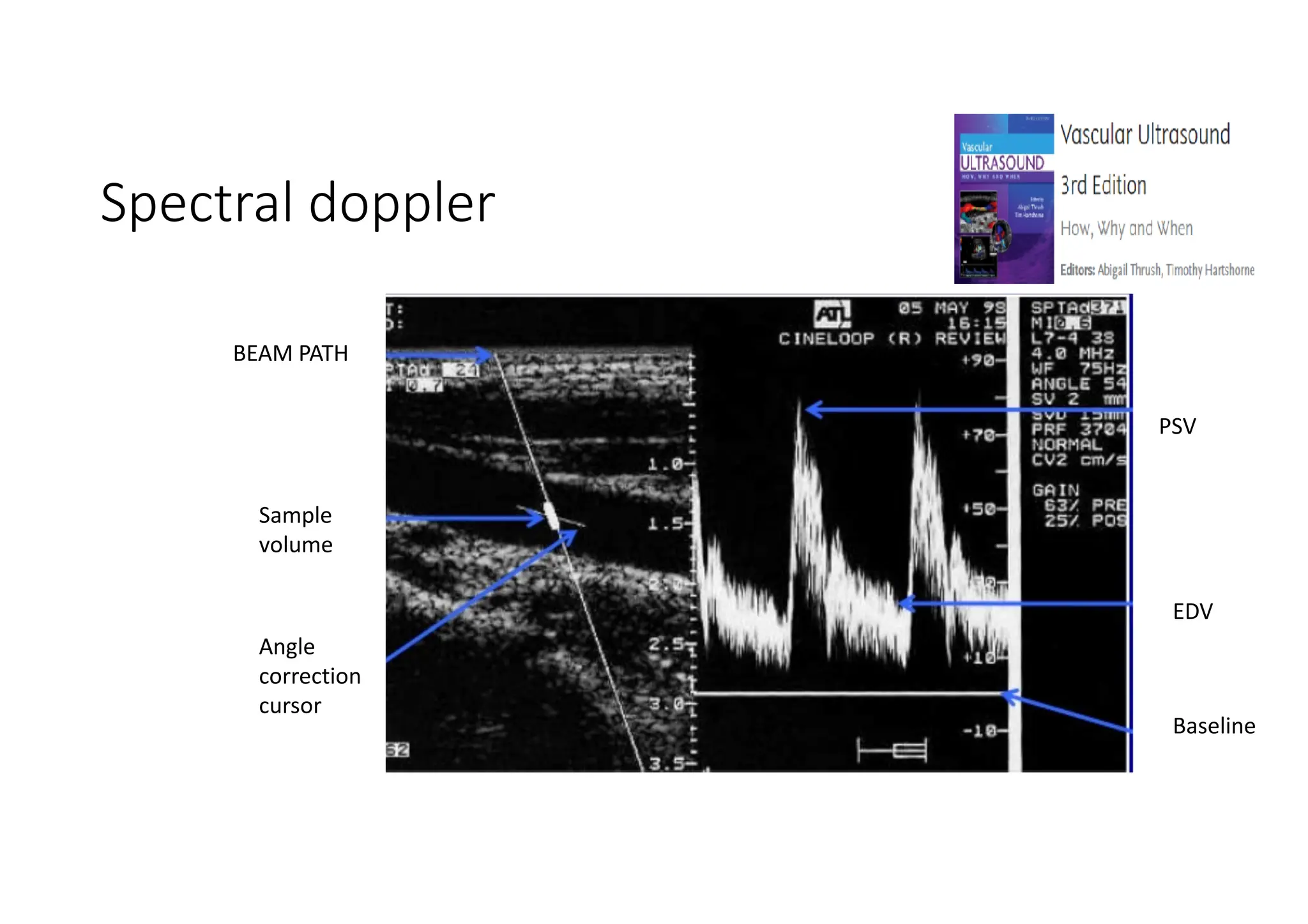 doppler gynecology pdf doppler en gynécologie | PDF