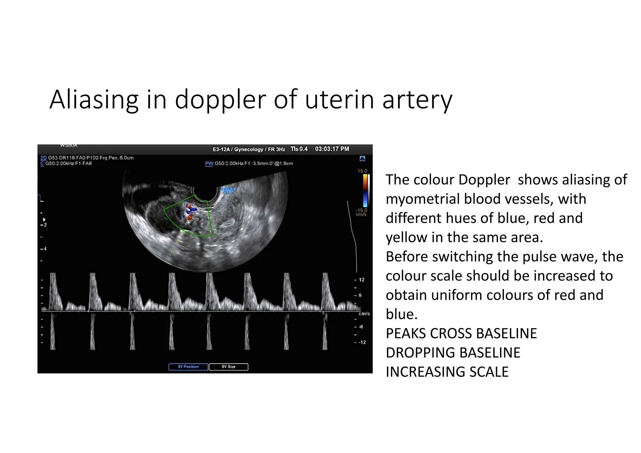 doppler gynecology pdf doppler en gynécologie | PDF