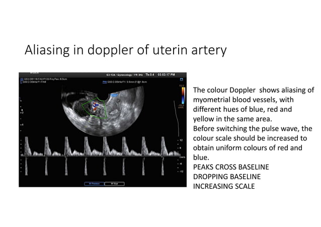 doppler gynecology pdf doppler en gynécologie | PPT