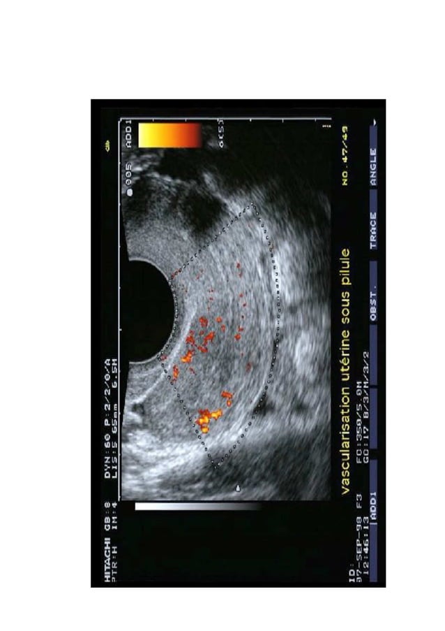 doppler gynecology pdf doppler en gynécologie | PPT
