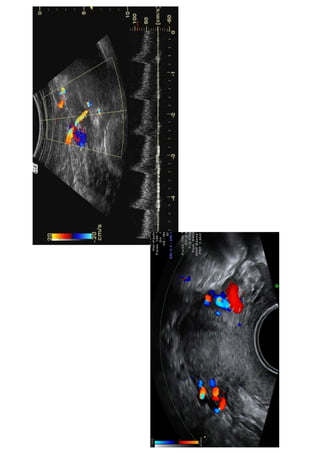 doppler gynecology pdf doppler en gynécologie | PDF