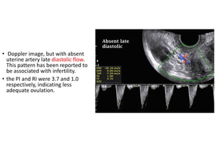 doppler gynecology pdf doppler en gynécologie | PDF