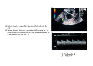 doppler gynecology pdf doppler en gynécologie | PDF