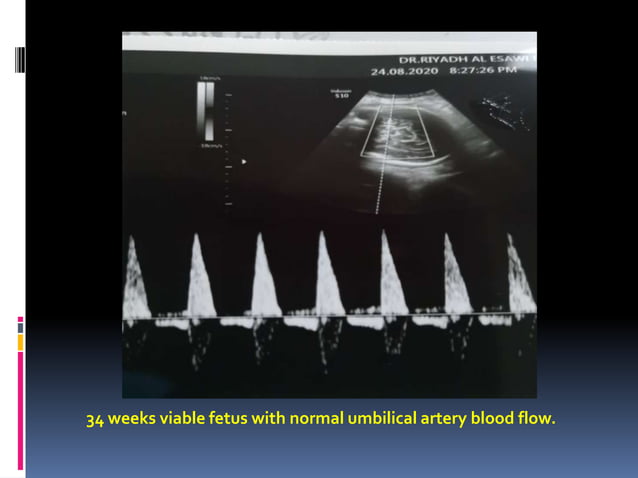 Doppler in obstetric power point presentation (4) | PPTX