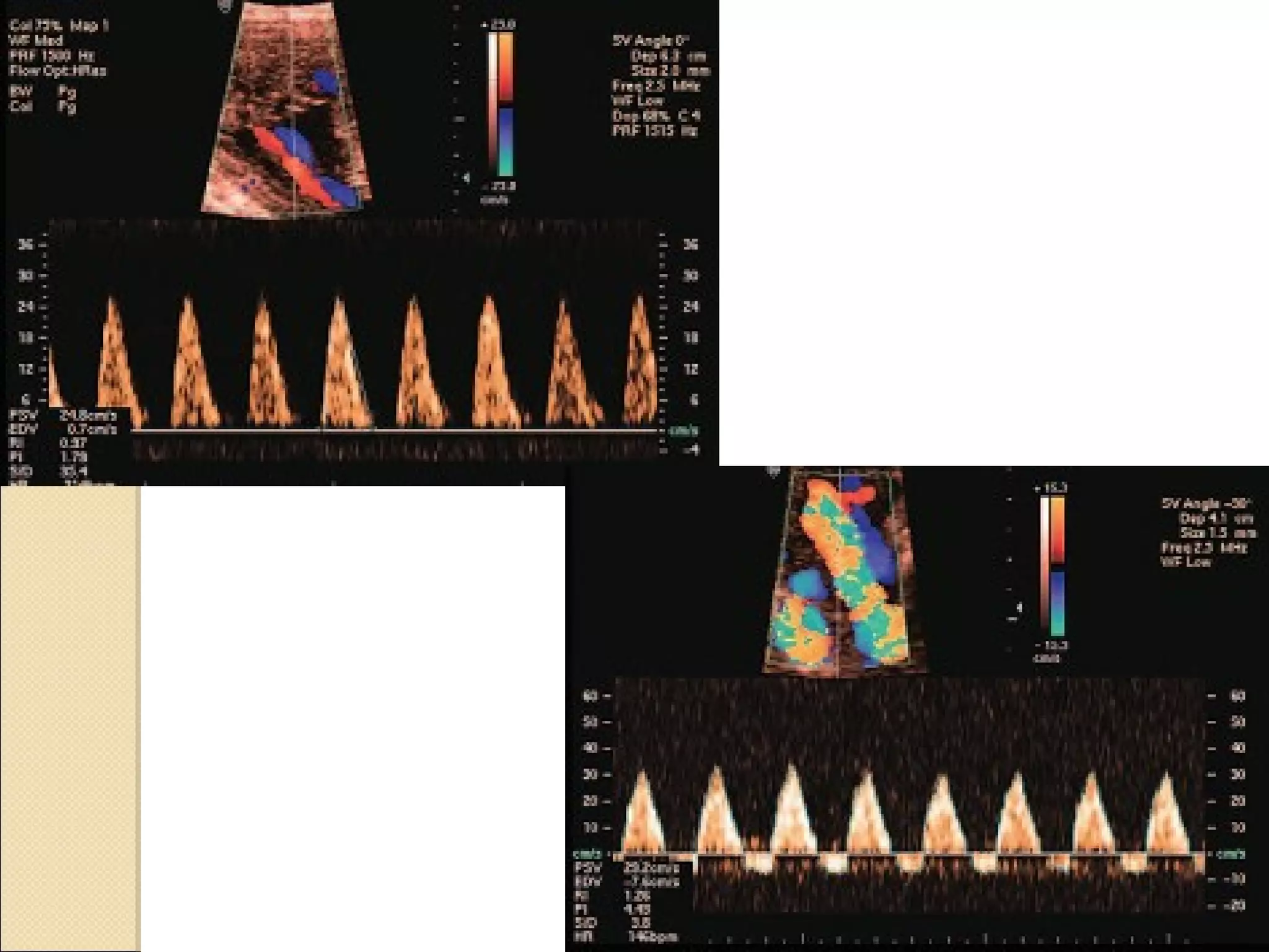 Doppler in pregnancy | PPT