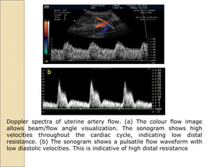 Doppler in pregnancy | PPT