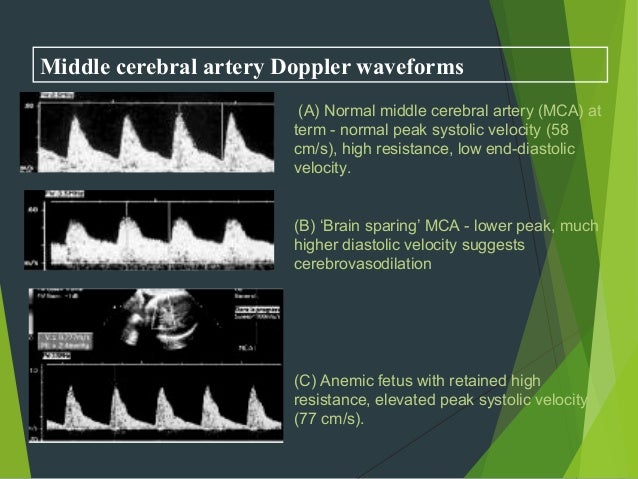 DEB BISWAS MDRD Doppler in pregnancy