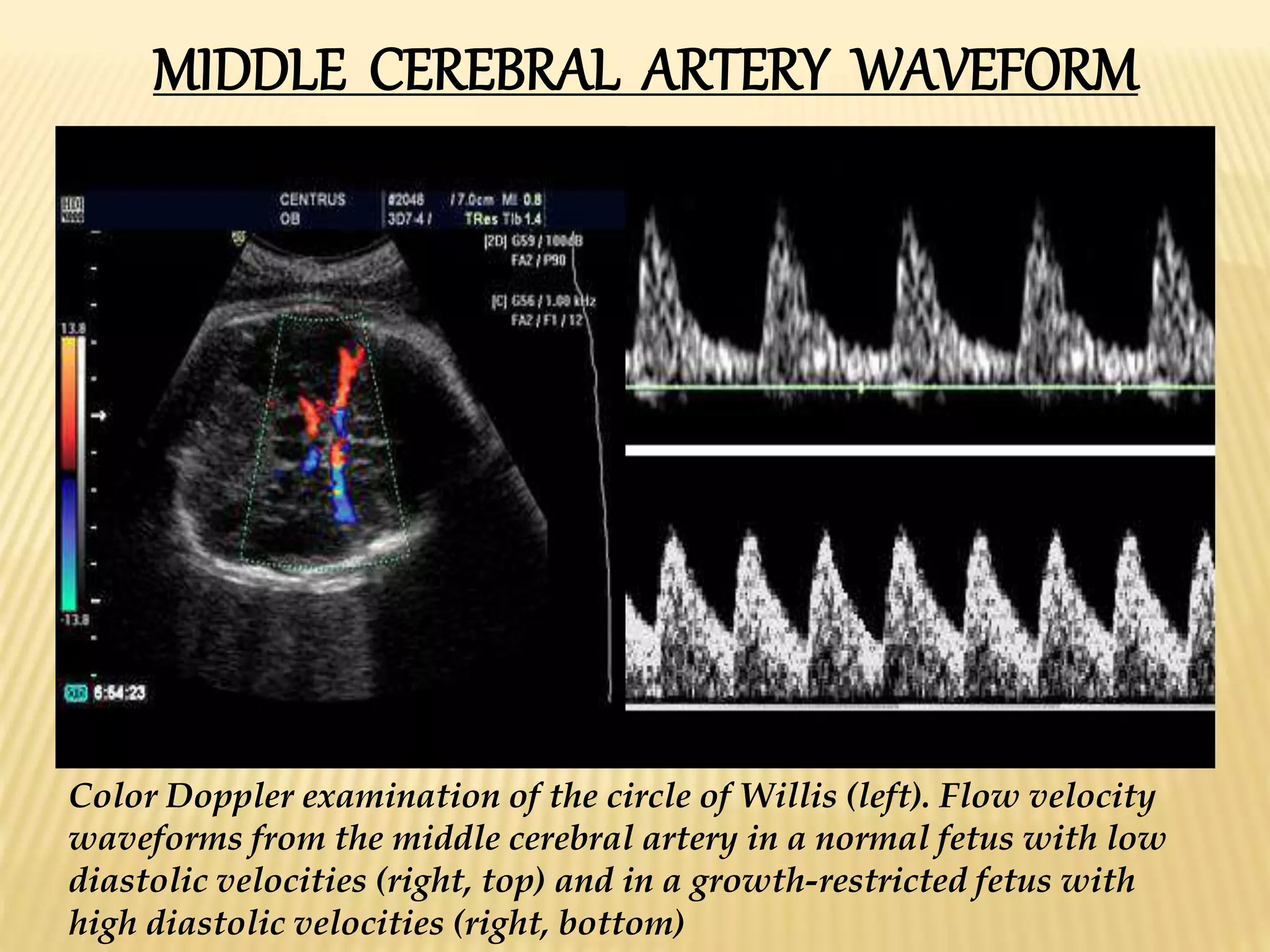 Doppler in pregnancy | PPTX