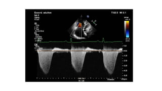 Doppler Normal ECOCARDIOGRAMA CARDIOLFIA | PPTX