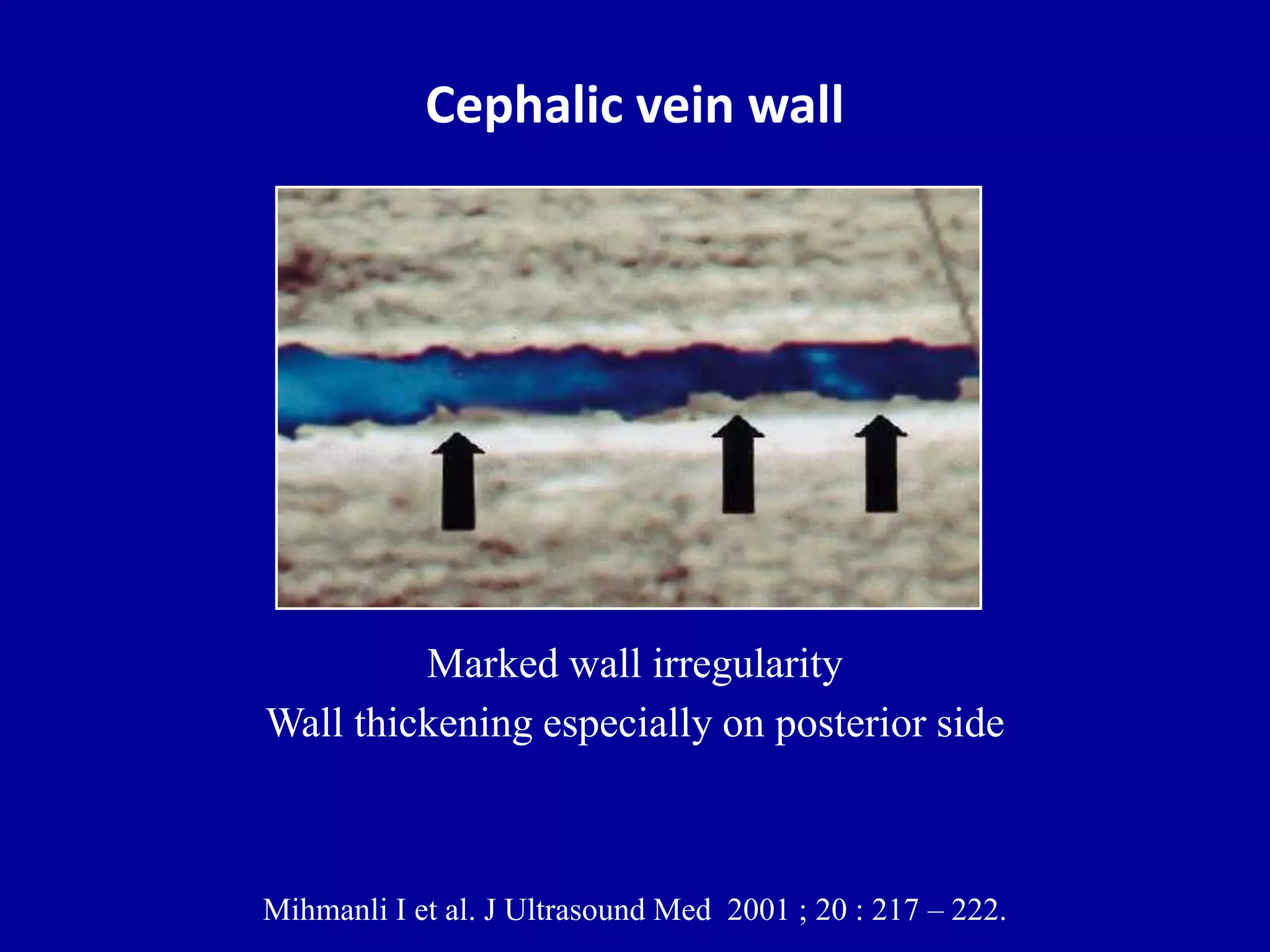 Doppler ultrasound of A-V access for hemodialysis | PPTX