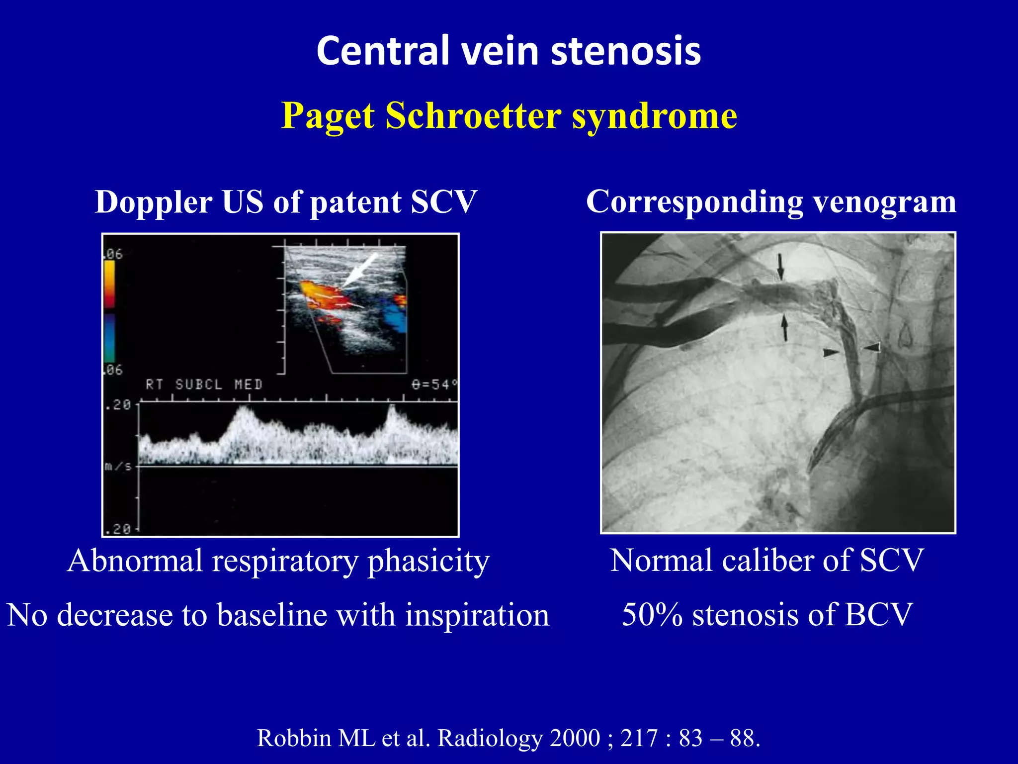 Doppler ultrasound of A-V access for hemodialysis | PPTX