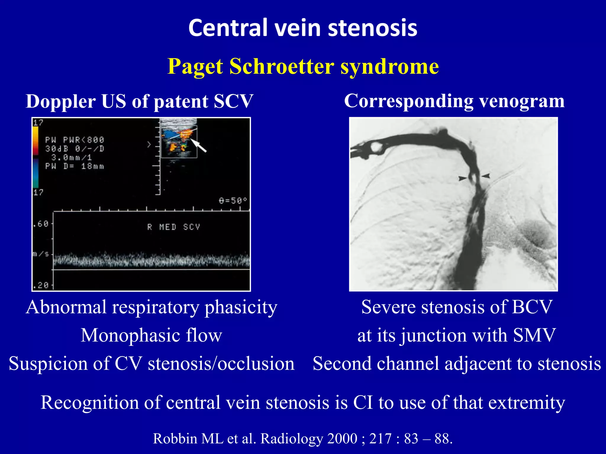 Doppler ultrasound of A-V access for hemodialysis | PPTX