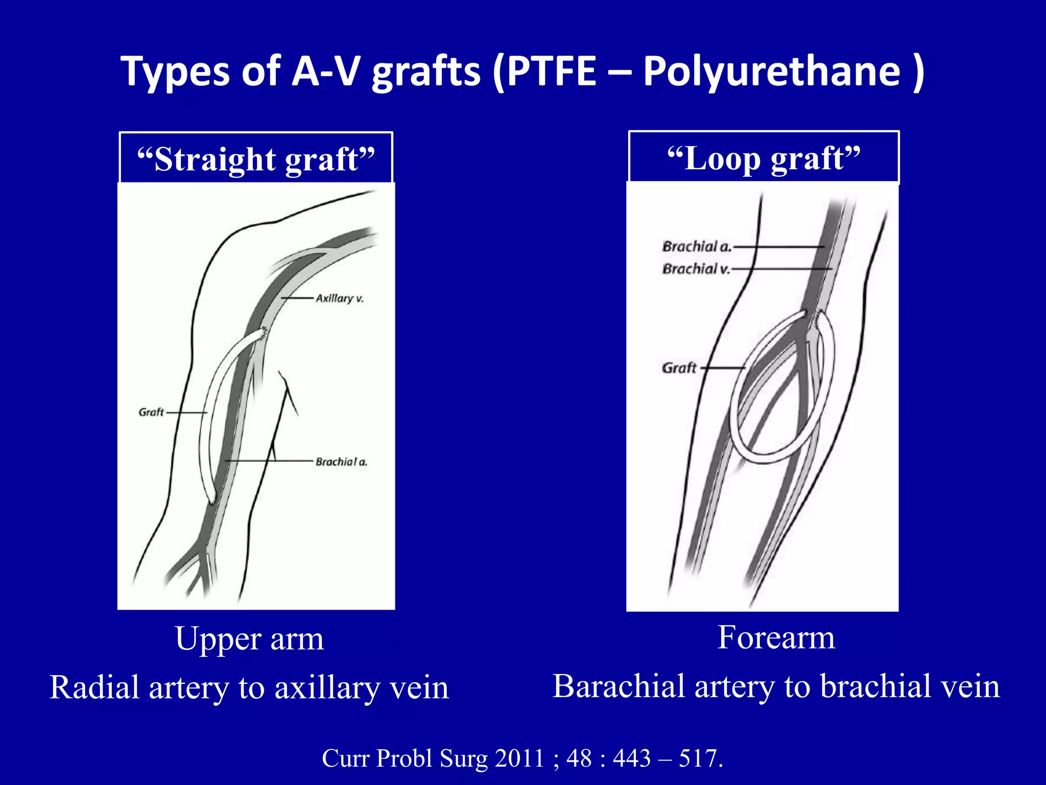 Doppler ultrasound of A-V access for hemodialysis | PPTX