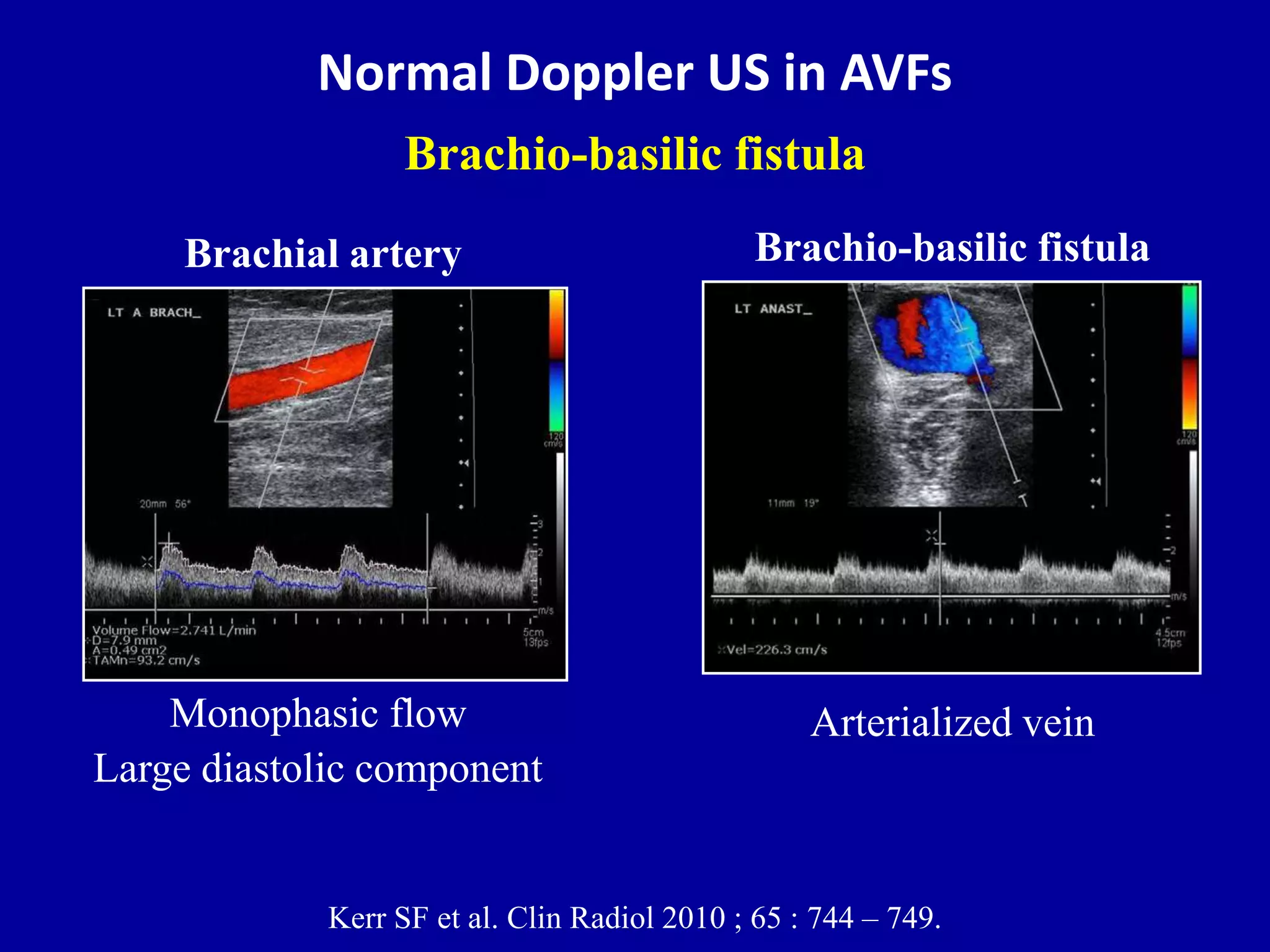Doppler ultrasound of A-V access for hemodialysis | PPTX