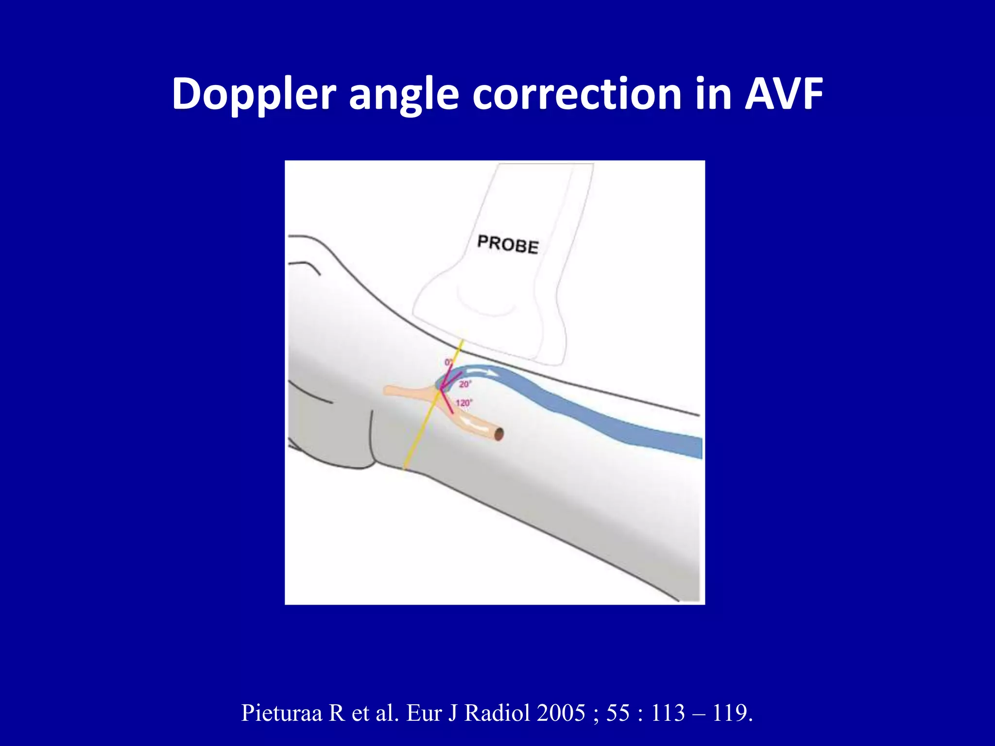 Doppler ultrasound of A-V access for hemodialysis | PPTX