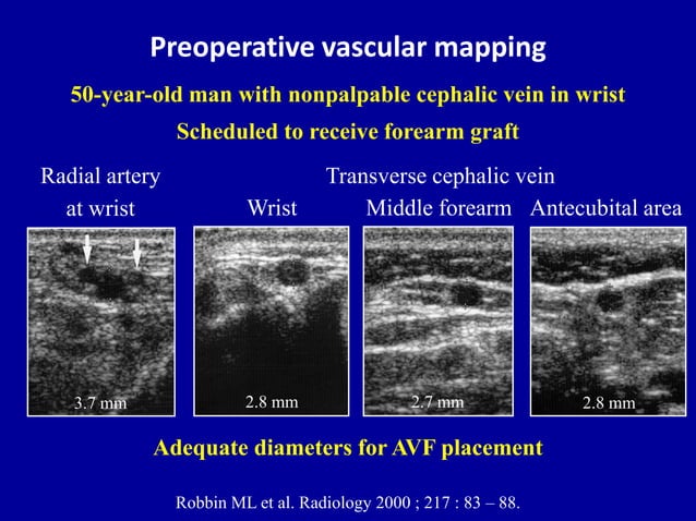 Doppler ultrasound of A-V access for hemodialysis | PPTX