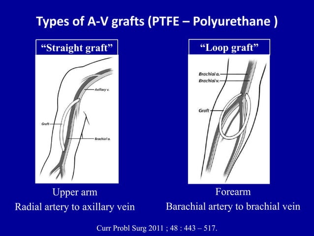 Doppler ultrasound of A-V access for hemodialysis | PPTX