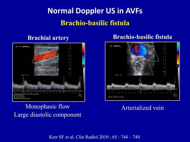 Doppler ultrasound of A-V access for hemodialysis | PPTX