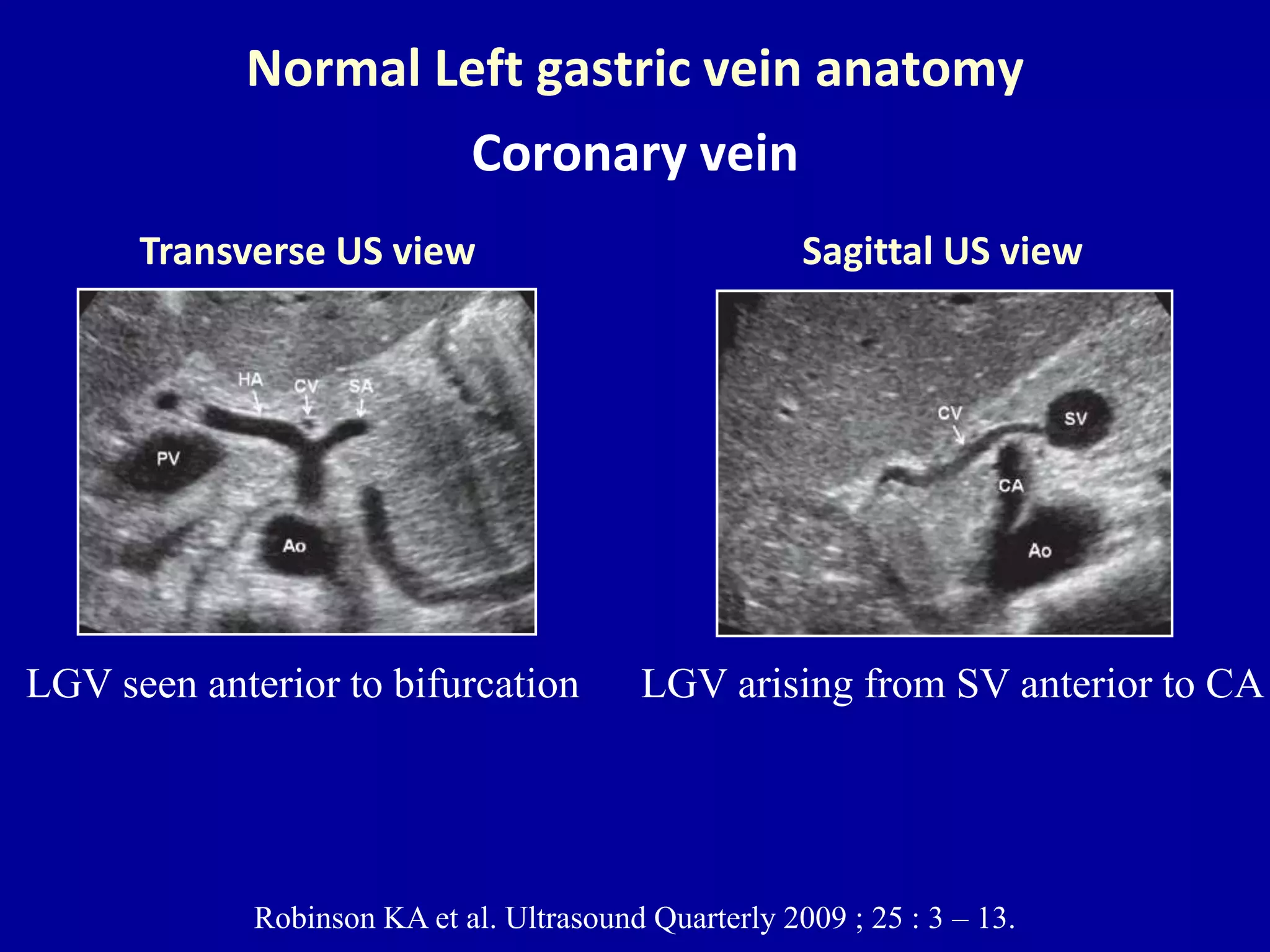 Doppler ultrasound of the portal system - Normal findings | PPTX