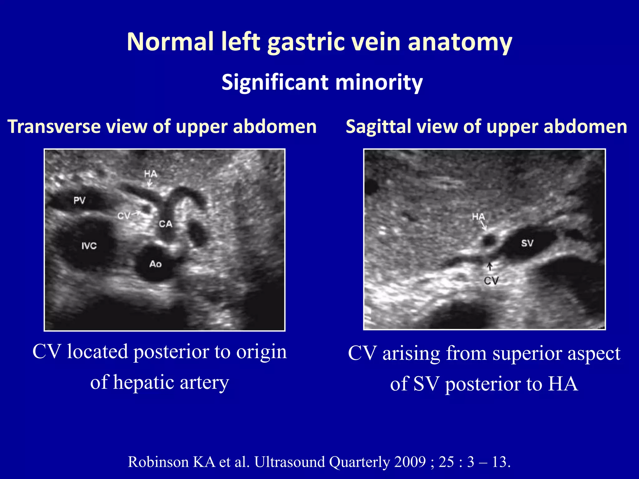 Doppler ultrasound of the portal system - Normal findings | PPTX