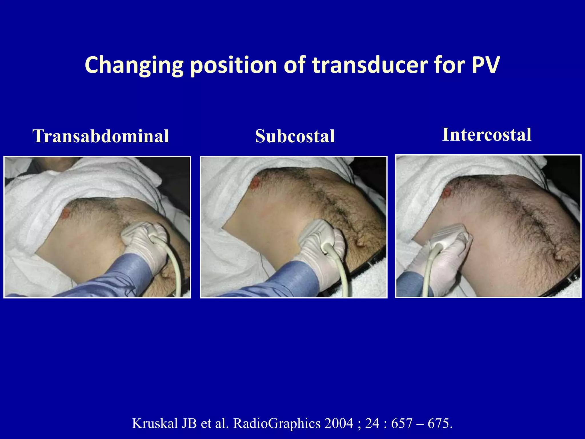 Doppler ultrasound of the portal system - Normal findings | PPTX