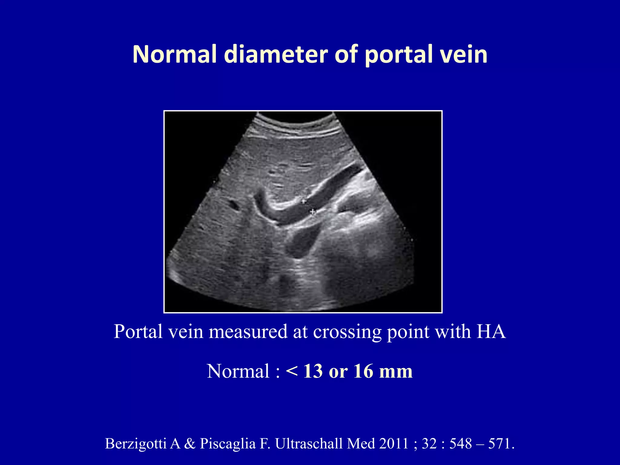 Doppler ultrasound of the portal system - Normal findings | PPTX
