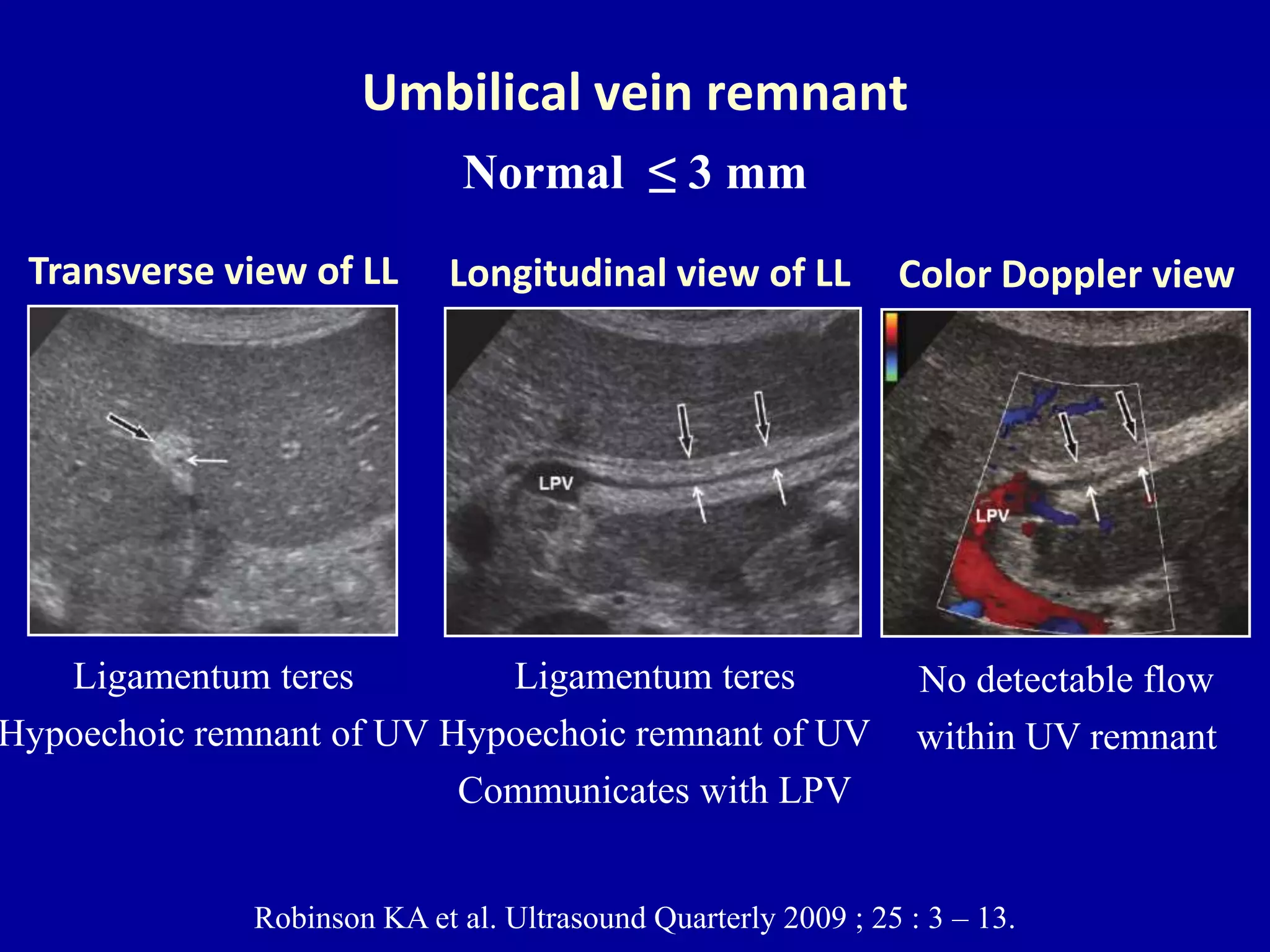 Doppler ultrasound of the portal system - Normal findings | PPTX