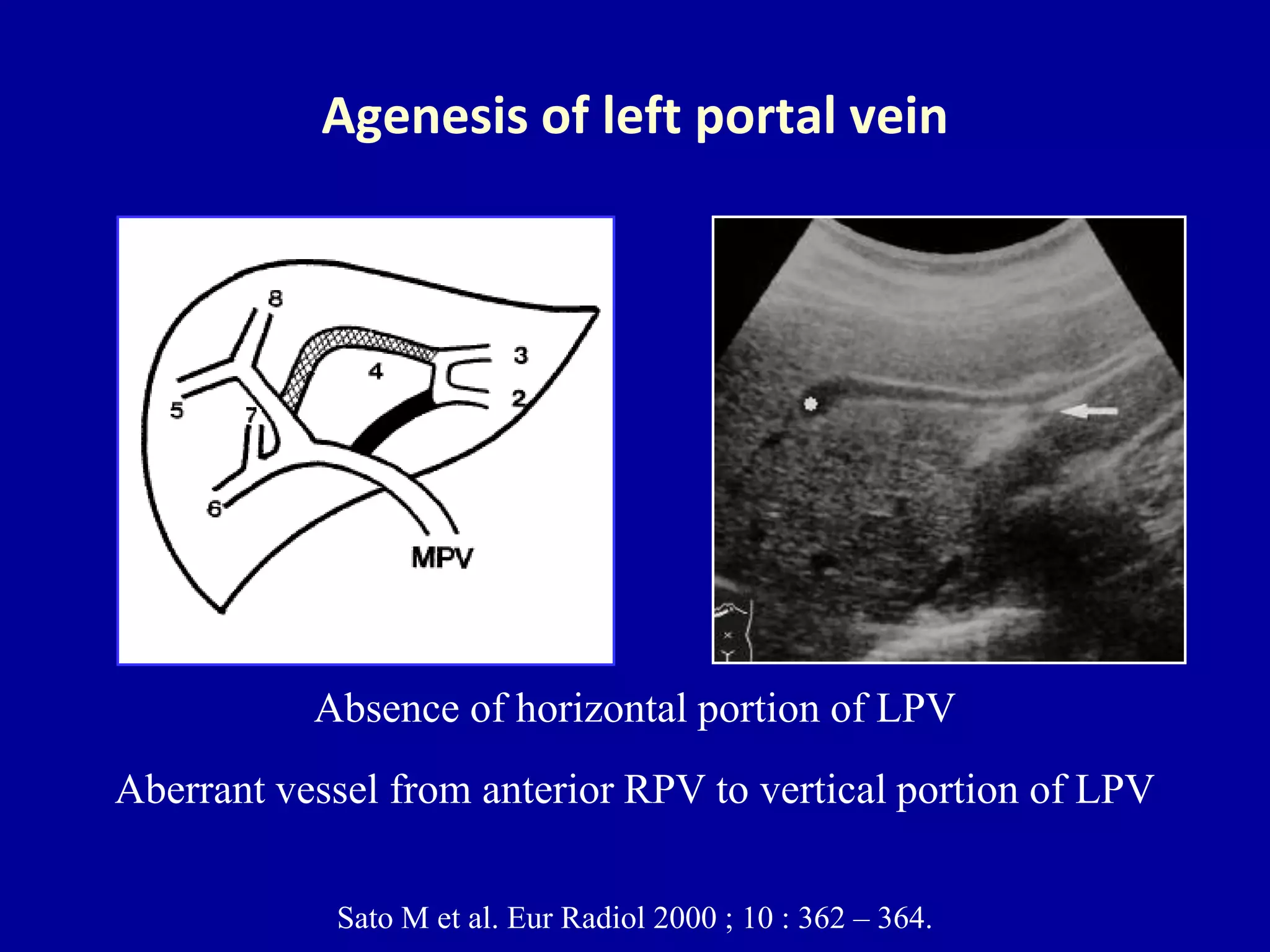 Doppler ultrasound of the portal system - Normal findings | PPTX