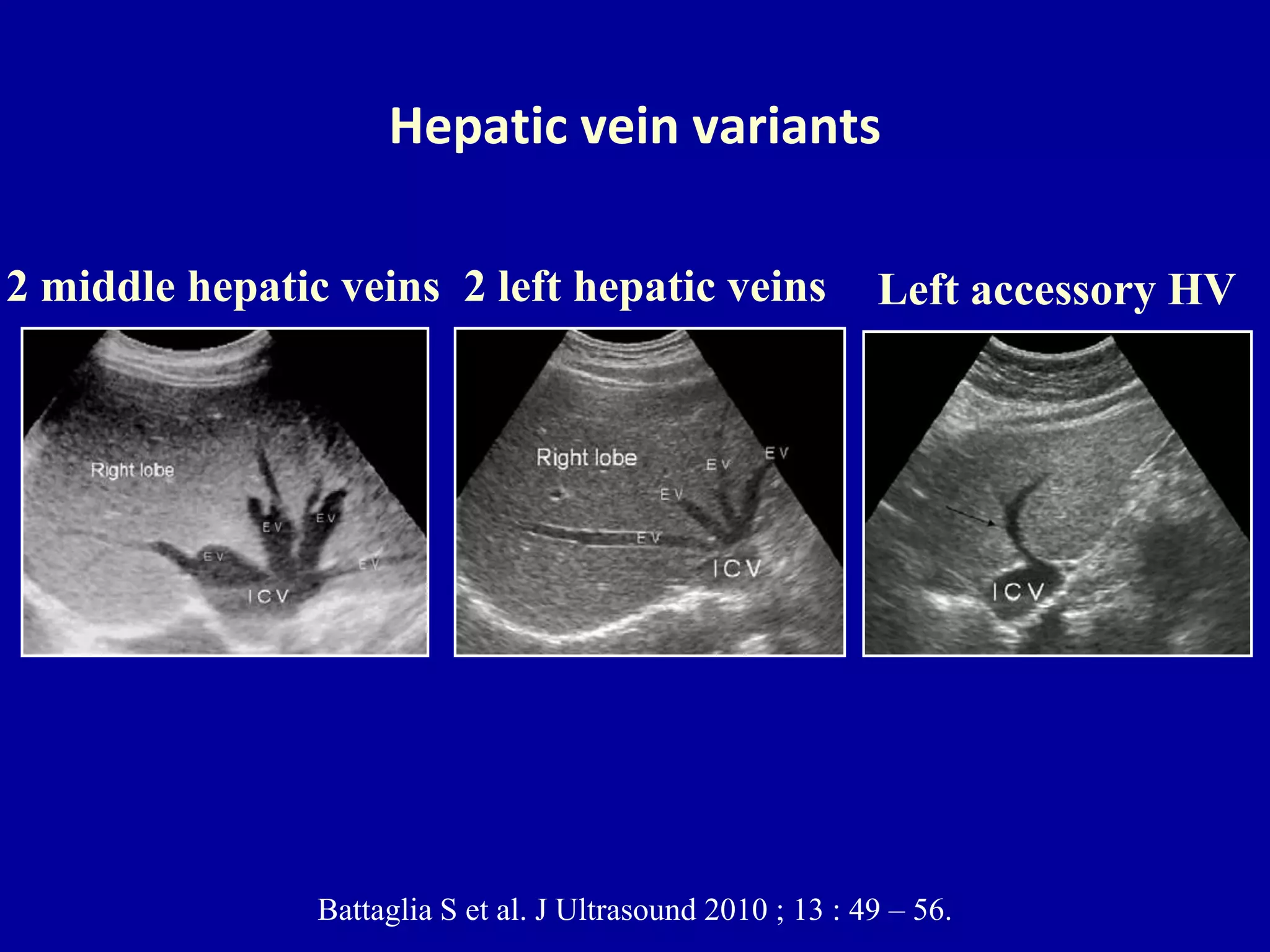 Doppler ultrasound of the portal system - Normal findings | PPTX