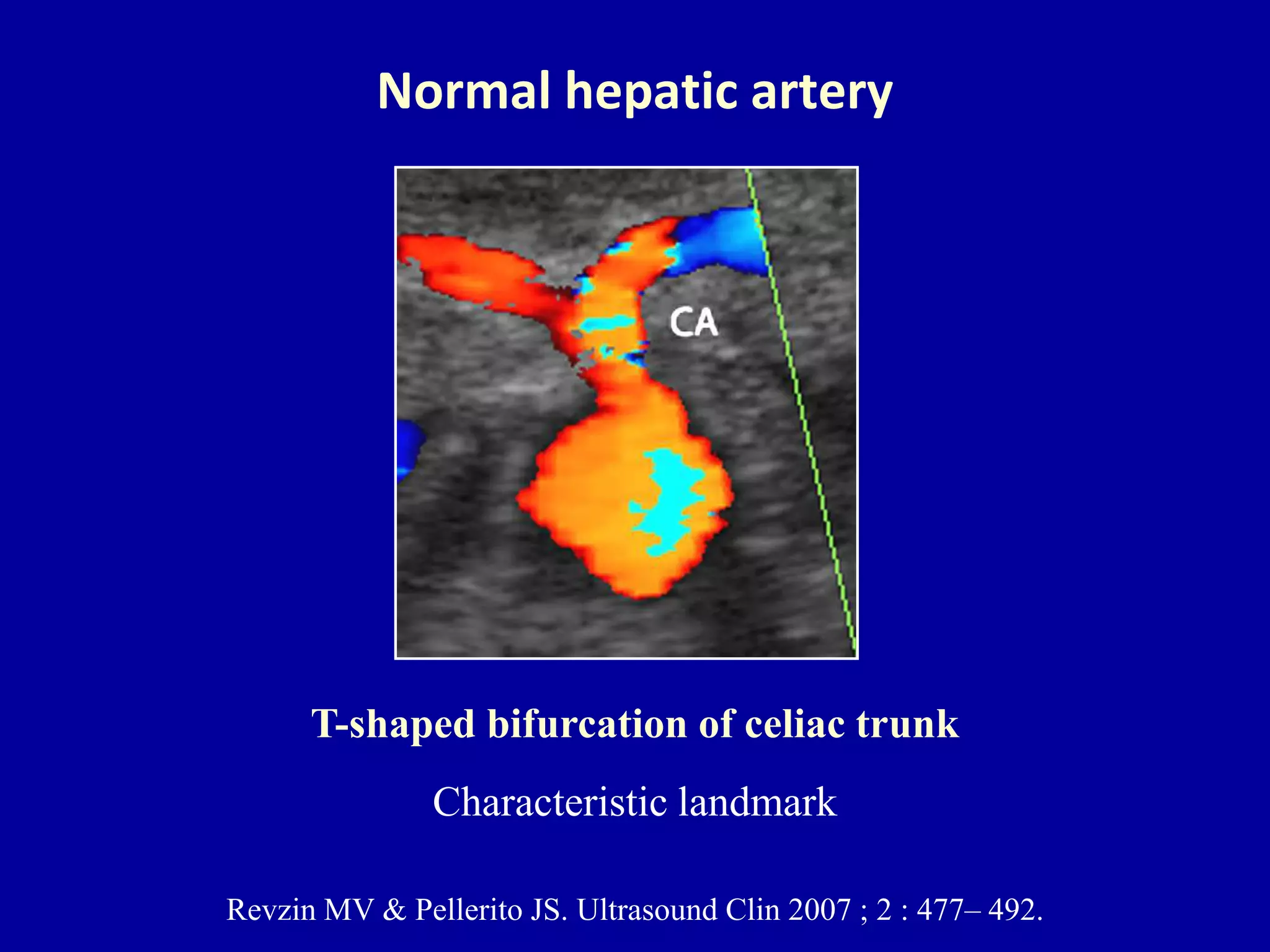 Doppler ultrasound of the portal system - Normal findings | PPTX