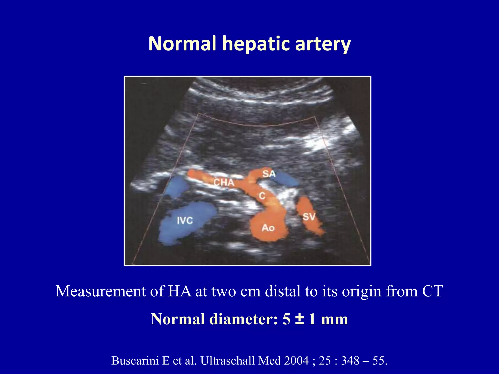 Doppler ultrasound of the portal system - Normal findings | PPTX