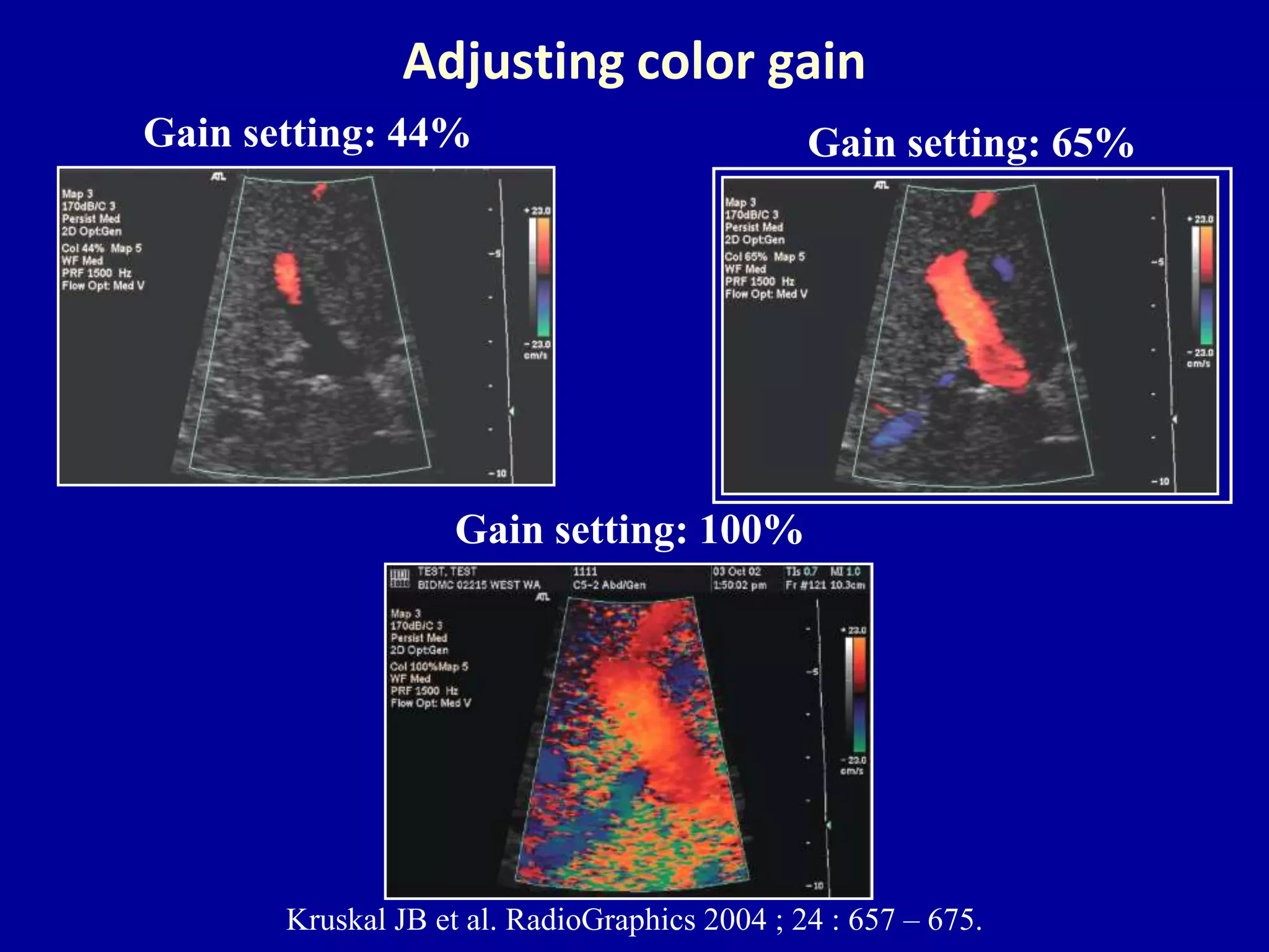Doppler ultrasound of the portal system - Normal findings | PPTX
