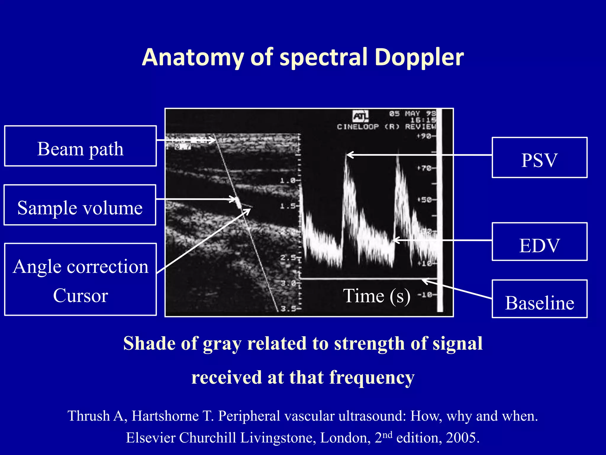 Doppler ultrasound of the portal system - Normal findings | PPTX