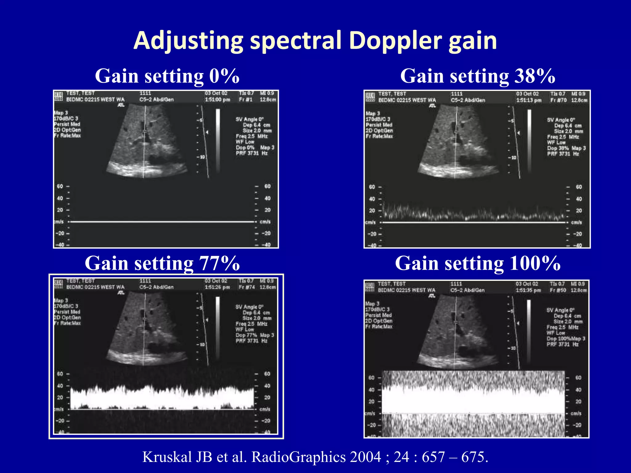 Doppler ultrasound of the portal system - Normal findings | PPTX