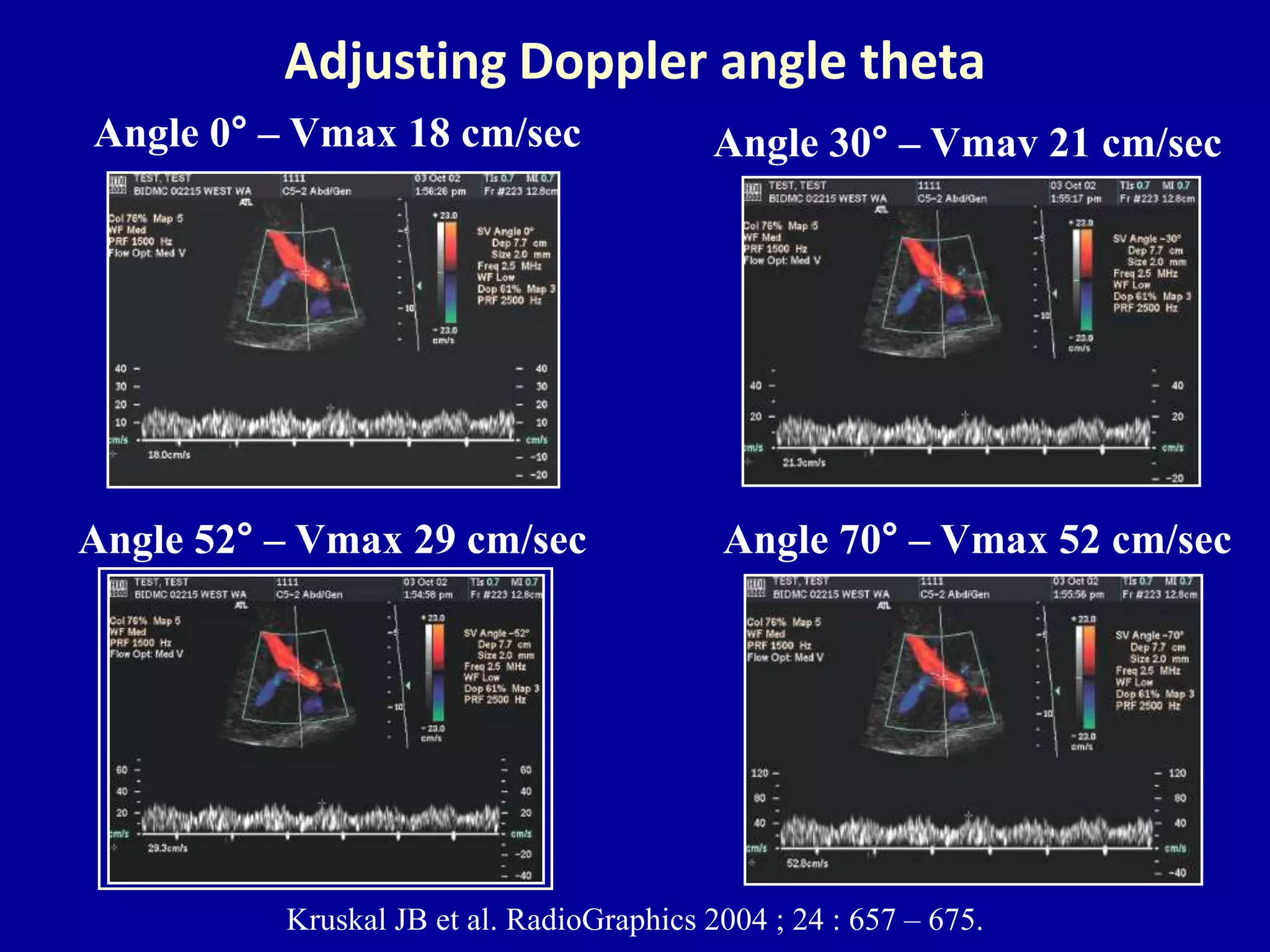 Doppler ultrasound of the portal system - Normal findings | PPTX