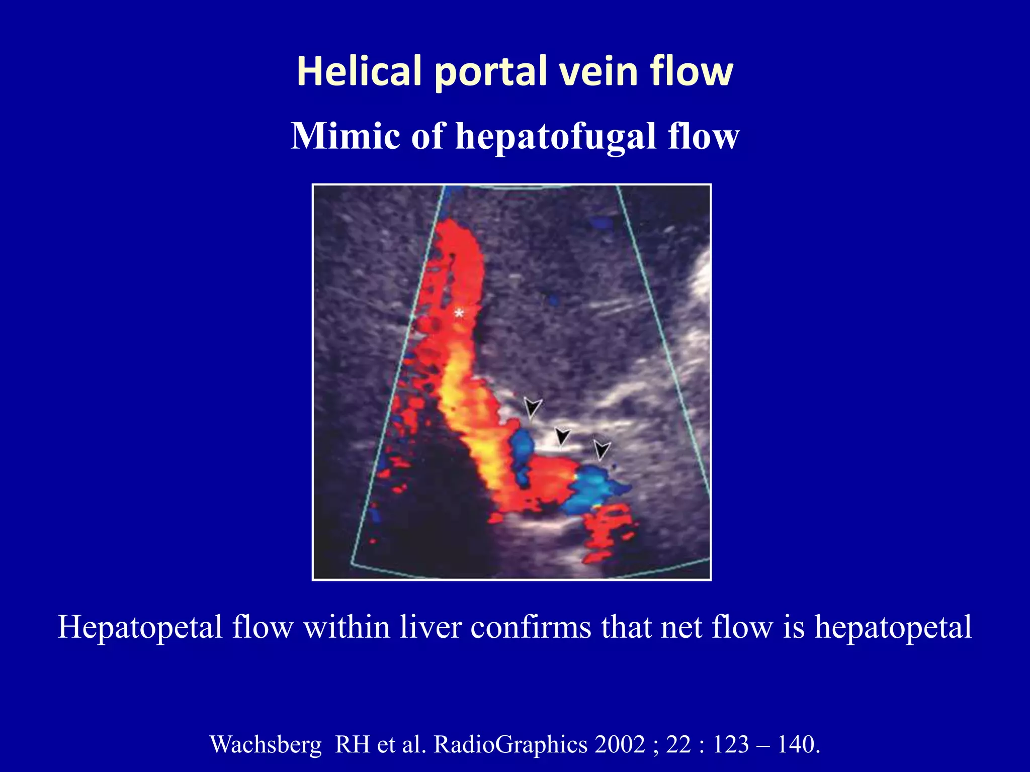 Doppler ultrasound of the portal system - Normal findings | PPTX