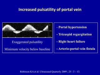 Normal Portal Vein Ultrasound