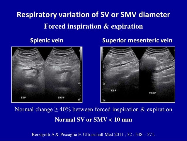 Doppler ultrasound of the portal system - Normal findings