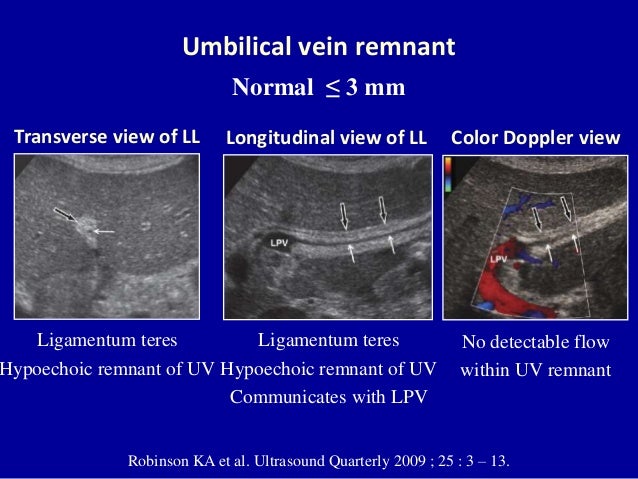 Doppler ultrasound of the portal system - Normal findings