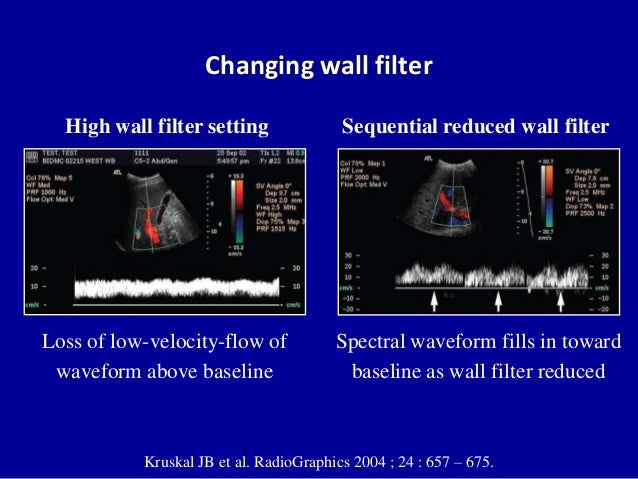 Doppler ultrasound of the portal system - Normal findings