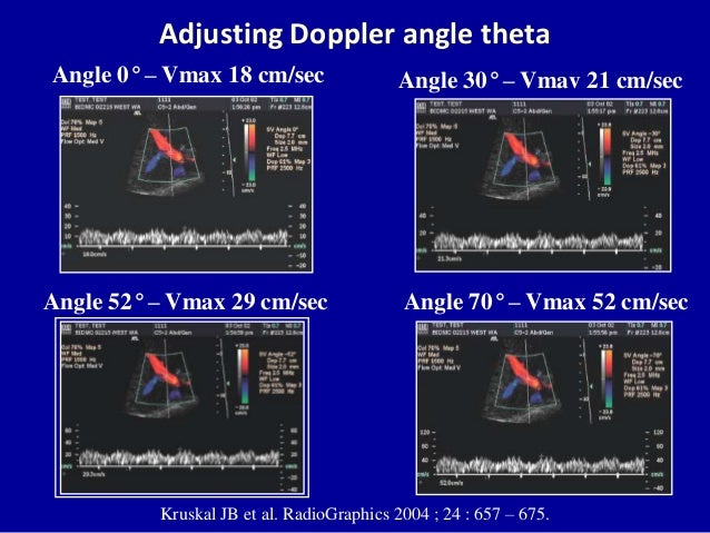 Doppler ultrasound of the portal system - Normal findings