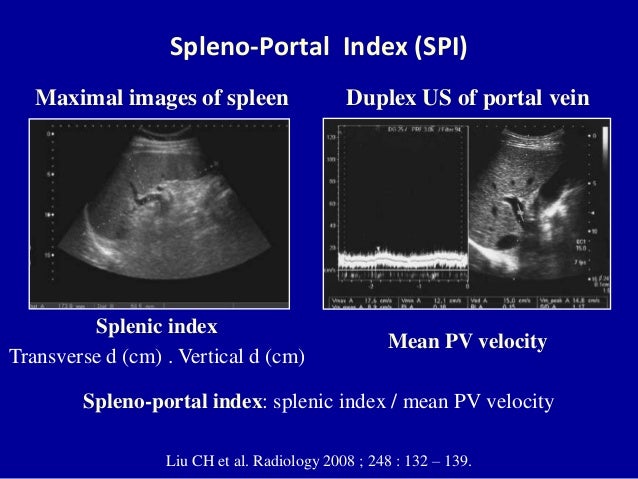 Doppler ultrasound of the portal system - Normal findings