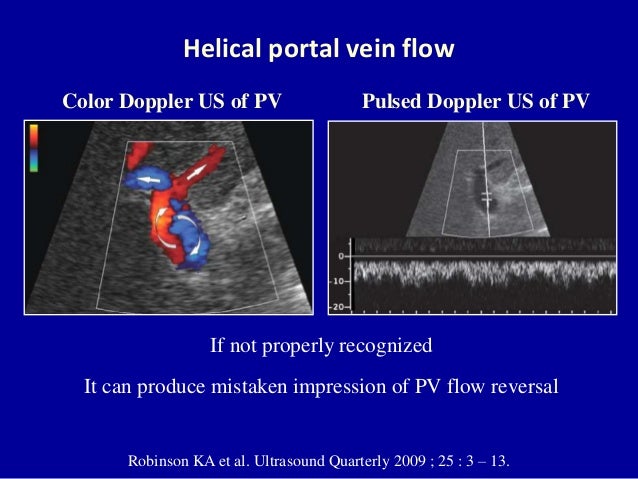 Doppler ultrasound of the portal system - Normal findings