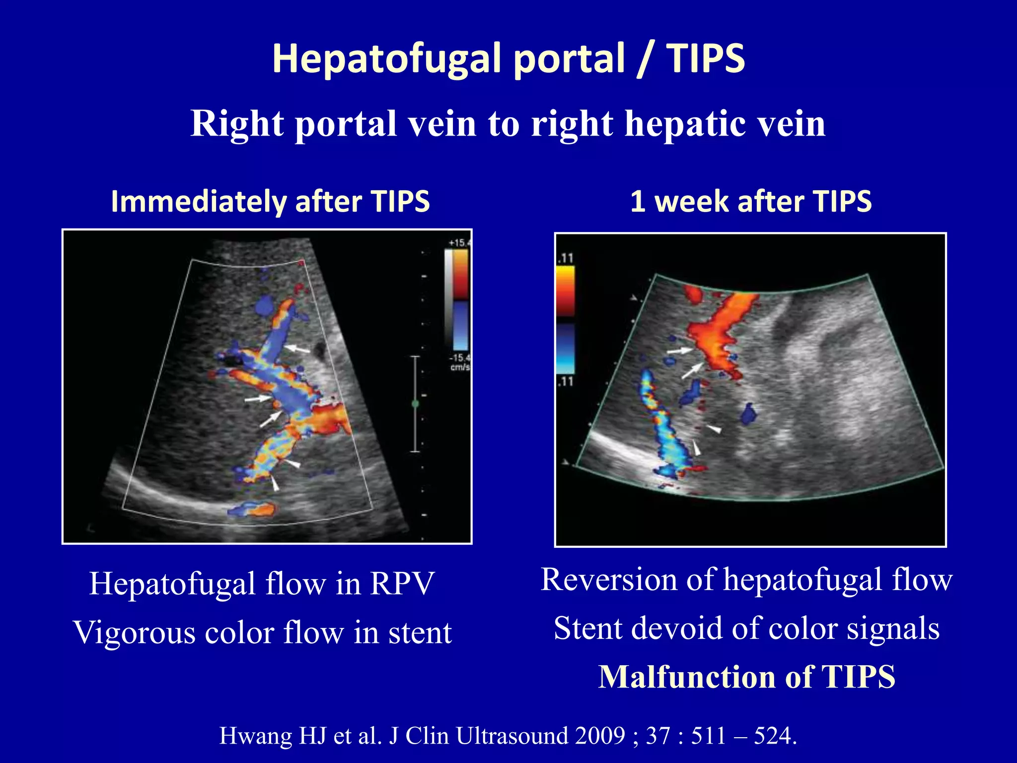 Doppler ultrasound of the portal system - Pathological findings