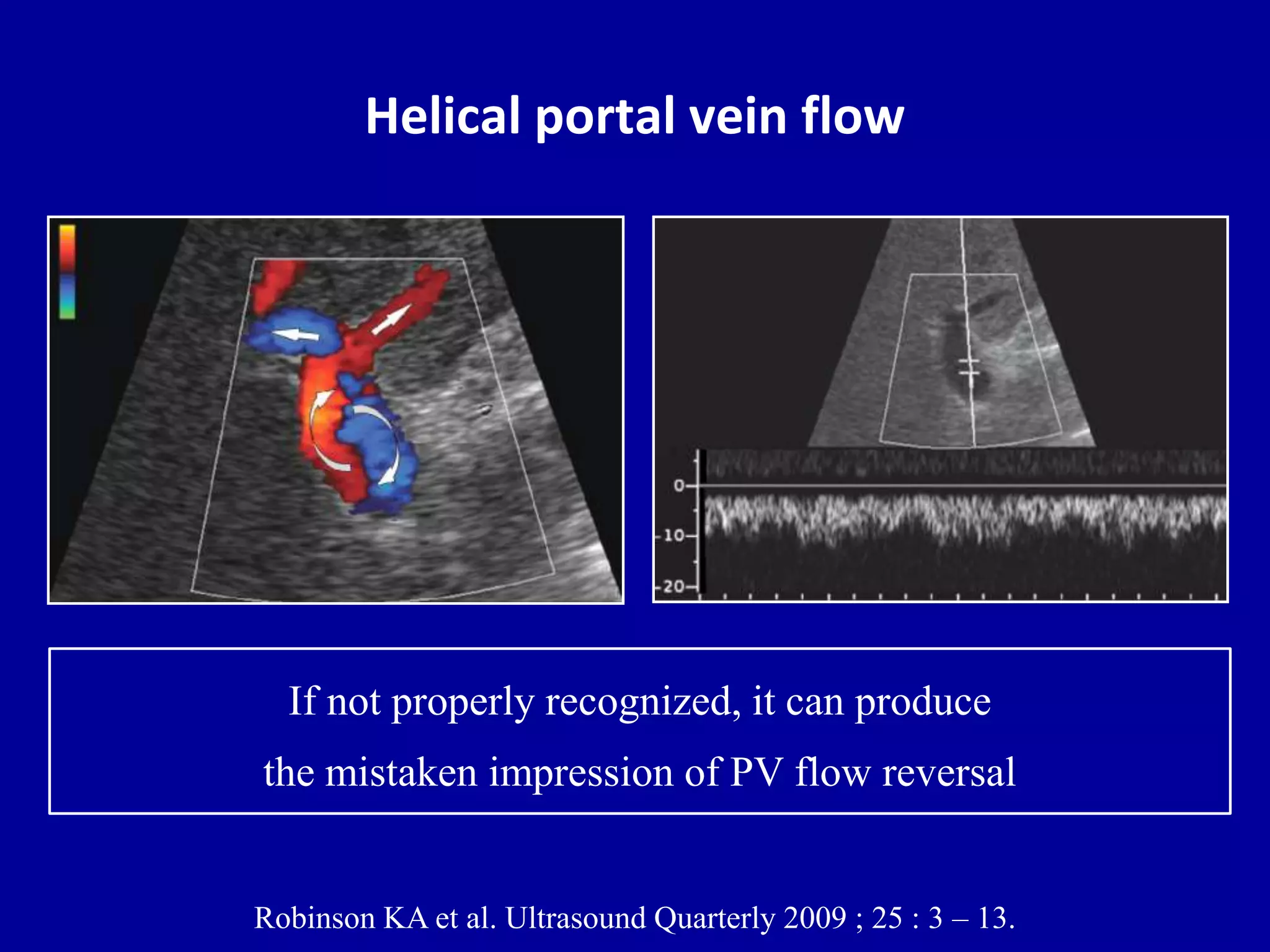 Doppler ultrasound of the portal system - Pathological findings