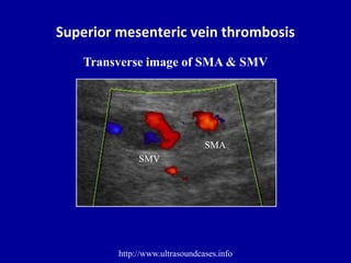 Superior Mesenteric Vein Ultrasound