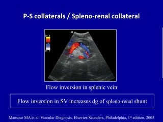 Splenorenal Shunt Ultrasound