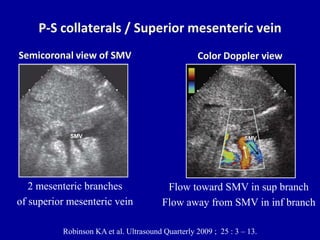 Superior Mesenteric Vein Ultrasound