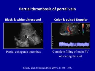 Superior Mesenteric Vein Thrombosis Ultrasound